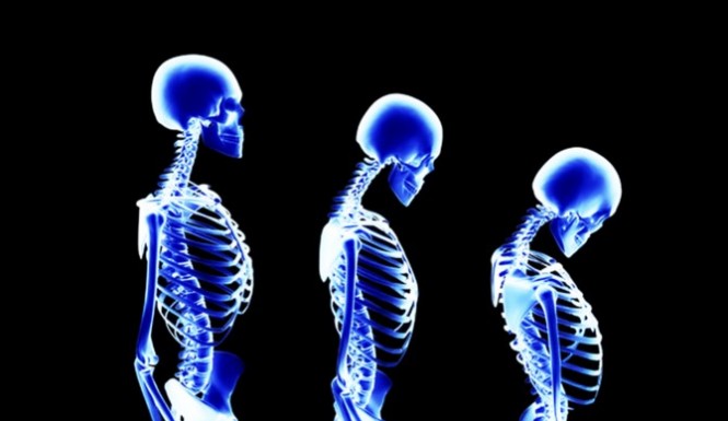 Bone-Paste-Osteoporosis-665x385 - Lori Michiel Fitness, Inc